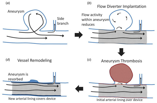 Brain aneurysm – flow diverter device – RS Neurology
